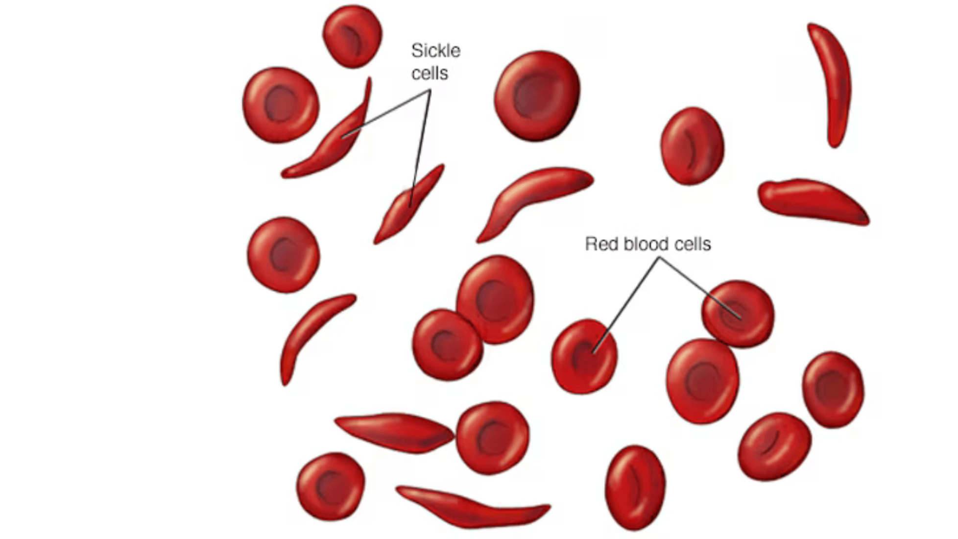FDA Approves Gene Therapy for Sickle Cell Disease | Nurse.Org